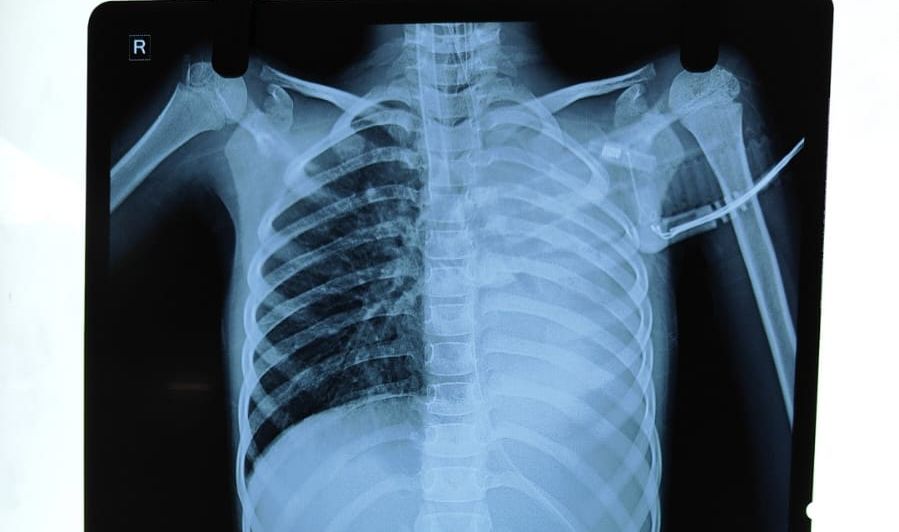 Chest physiotherapy for Pediatric lung collapse on mechanical ...